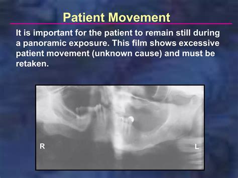 Panoramic Techique Errors Pptx Panoramic Techique Errors Pptx