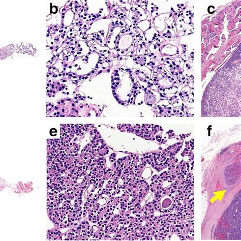 Representative Examples Of Follicular Thyroid Adenoma Fta And