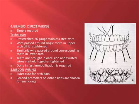 Mandibular Fracturepptx Mandibular Fracturepptx