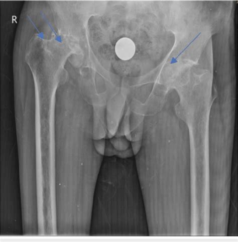 Figure 1 From Proprioceptive Neuromuscular Facilitation Pnf Integrated Gait Rehabilitation