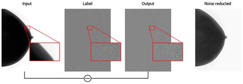Noise Reduction For A Virtual Grid Using A Generative Adversarial Network In Breast X Ray Images