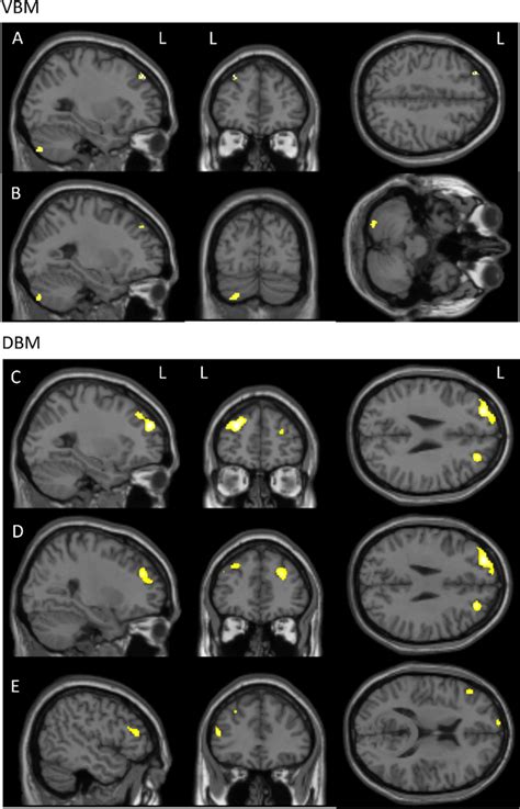 Gray Matter Volume Reduction From Baseline To Follow Up In Breast