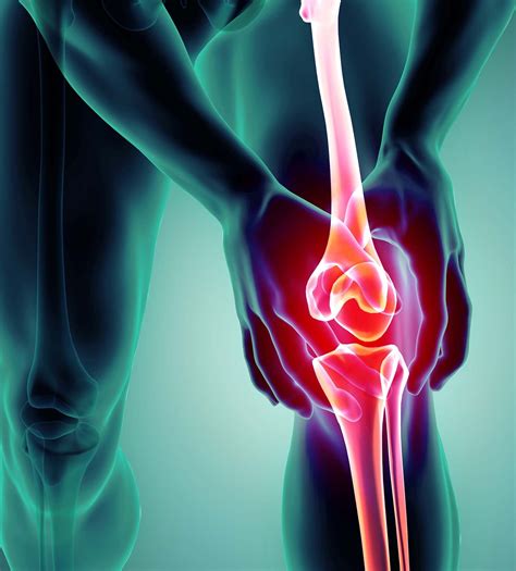 Bone Marrow Edema Not Just Your Usual Swelling Artofit