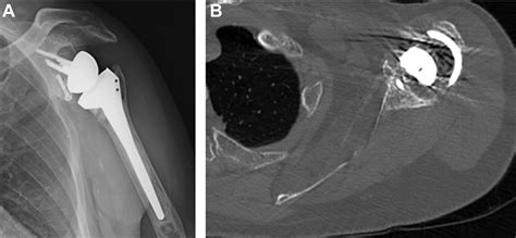 Glenoid Bone Grafting With Coracoid Transfer In Reverse Shoulder