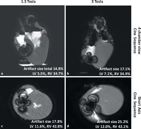 Visualization And Appearance Of Artifacts Of Leadless Pacemaker Systems