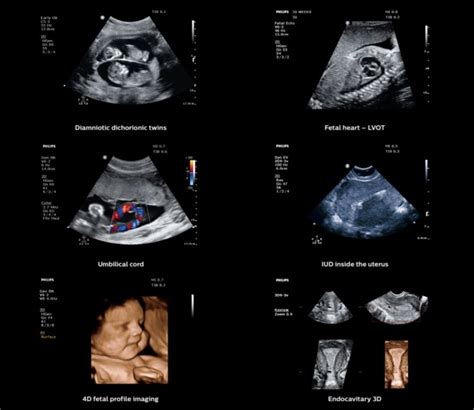 2d Philips Clearvue 350 Ultrasound System At Best Price In Gurugram Id 19286131912