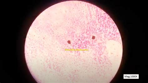 Pneumococcus Vs Viridans Streptococci Introduction Differentiating Features Keynotes
