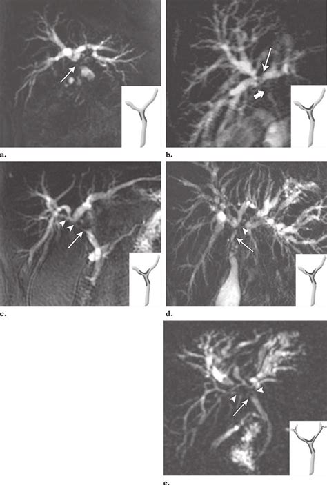 Bismuth Corlette Classification Scheme For Cholangiocarcinomas Mr