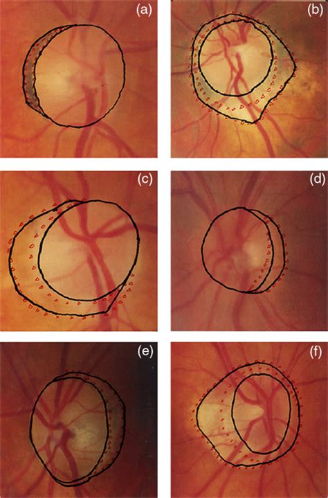 Optic Nerve Peripapillary Atrophy
