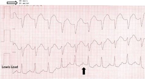 The Lewis Lead Emergency Medicine Education Resus