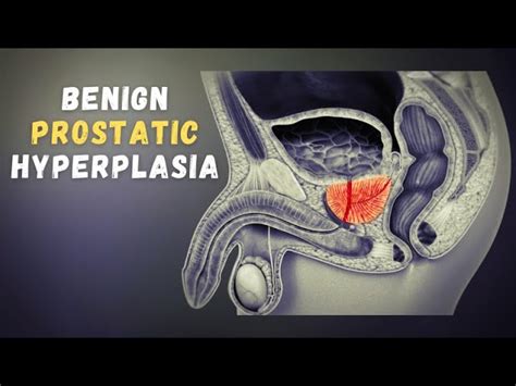 Benign Prostatic Hyperplasia X Ray Prostatitis Vs Bph Vs Prostate
