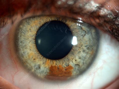 Iris Nevus Stock Image C027 2035 Science Photo Library