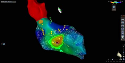 Carto 3d Mapping System Picture Of Ectopic Focus In The Left Ventricle