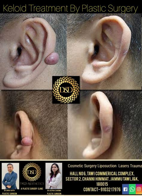 Lets Chat Keloids What Are Keloids Keloids Are A Type Of Hypertrophic Raised Scar Often