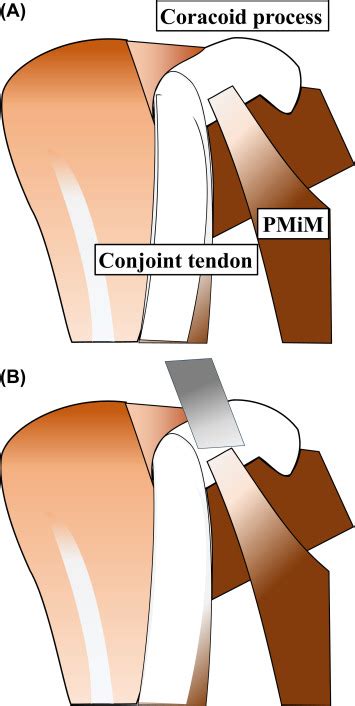 Anatomical Variations In Pectoralis Minor Muscle Attachment To The