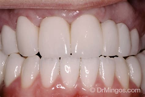 Before And After Portfolio Dr Mingos And Associates