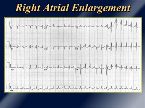Pediatric Egc Interpretation Overview Of Pediatric Ecg Pdf