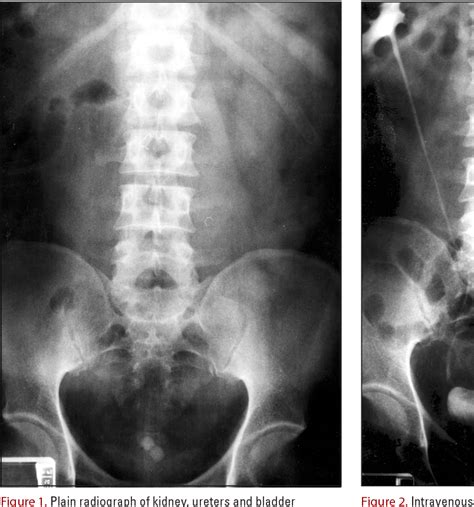 Figure 2 From Blind Ending Ureteral Duplication With Calculi Semantic