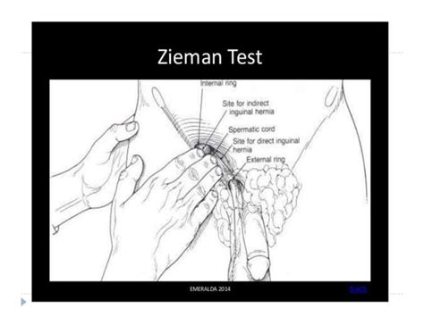 Inguinal And Femoral Hernia Pptx