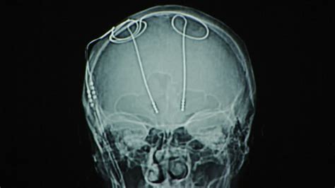 Deep Brain Stimulation Parkinsons Videos And Hd Footage Getty Images