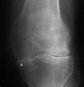 Standard Anteroposterior Knee Radiograph Showing Medial Joint Space