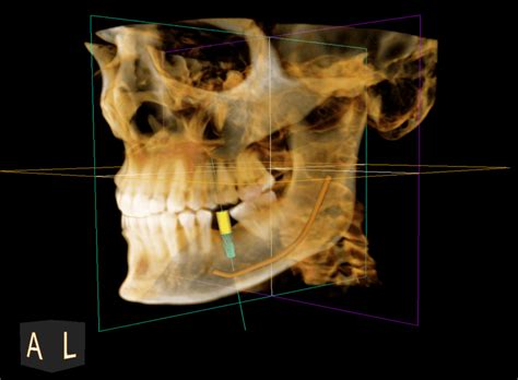 Bitewing X Rays In Toronto Atlas Dental