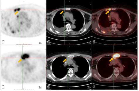 Internal Mammary Lymph Node Metastasis Yellow Arrow With Sternal Download Scientific Diagram