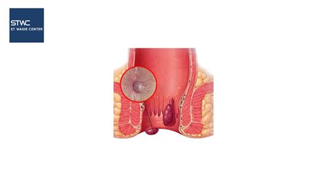 Ketahui Cara Menangani Benjolan Di Anus