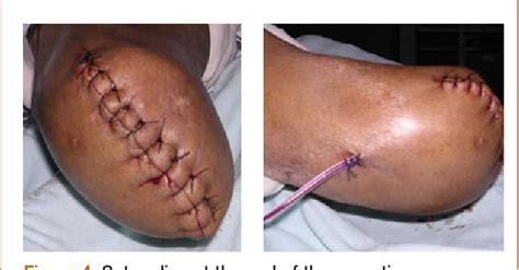 Figure 2 From Modified Skew Flap Below Knee Amputation Semantic Scholar