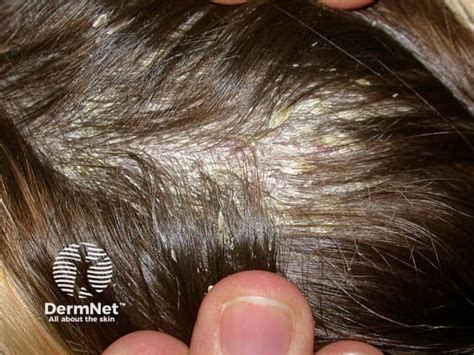 Chronic Plaque Psoriasis Causes Symptoms And Treatment