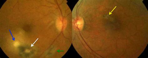 Toxoplasma Retinitis