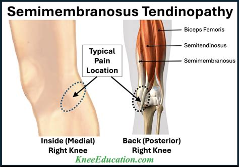 Semimembranosus Tendinopathy Knee Education