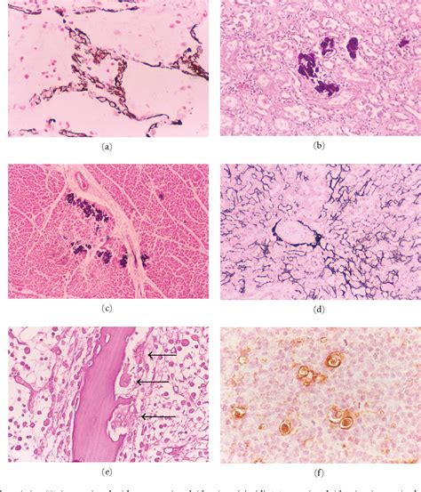 Figure 1 From Pathogenesis Of Metastatic Calcification And Acute Pancreatitis In Adult T Cell