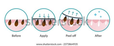 Dark Spots On Nose Over Royalty Free Licensable Stock Vectors Vector Art Shutterstock