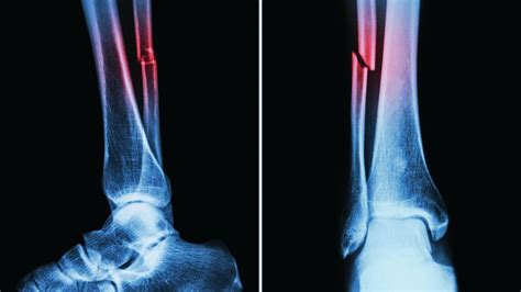 Help My Employee Has Two Fmla Reasons J J Keller® Compliance Network