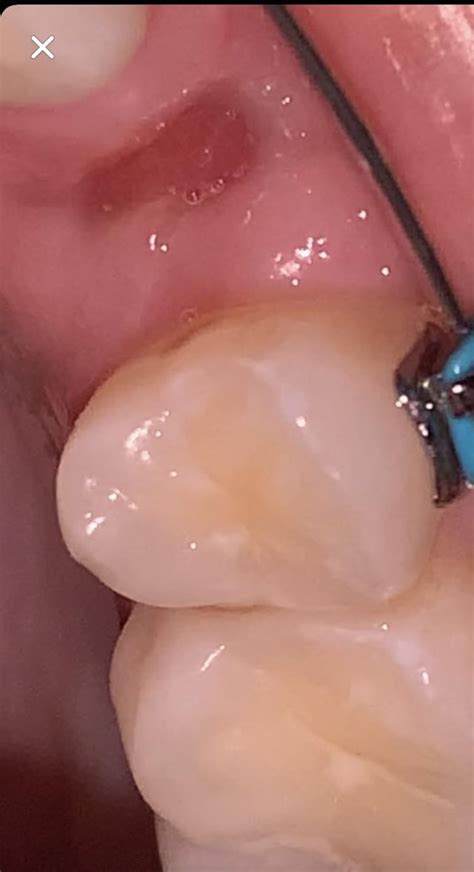 Premolar Extraction Rdentalhygiene
