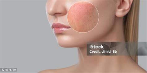 문제가 있는 피부를 가진 어린 소녀 사진 전후 여드름과 데모데코시스 치료 피부 트리트먼트 스파 트리트먼트 화장품 및 전문 스킨 케어 피부에 대한 스톡 사진 및 기타 이미지