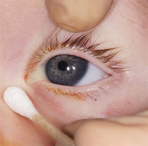 Full Article Congenital Nasolacrimal Duct Obstruction Early