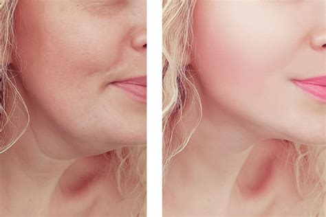 Biostimulator Injections In Mornington Elite Medical Centre