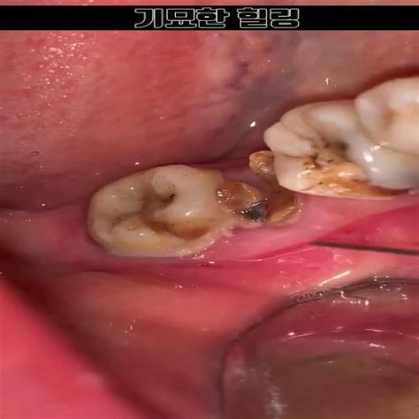 Caries Caries Syln2 Roboflow Universe