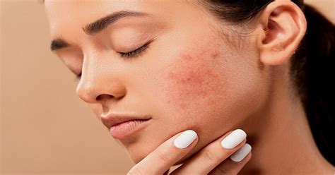 Causes Of Different Types Of Pimples And How To Deal With Them