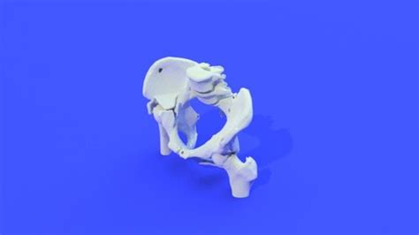 pelvis fractured stl file processed spine and pelvis