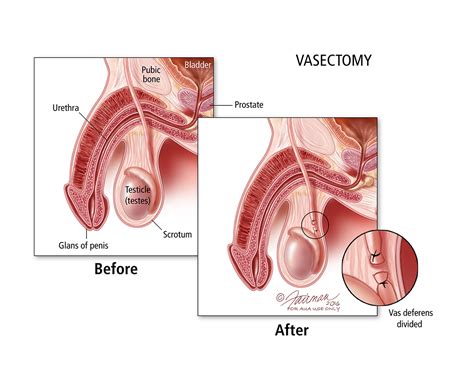 Vasectomy Treatment And Information Urology Care Foundation