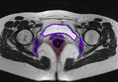 Segmentation Results Of Mr Image Using Region Growing Algorithm Download Scientific Diagram