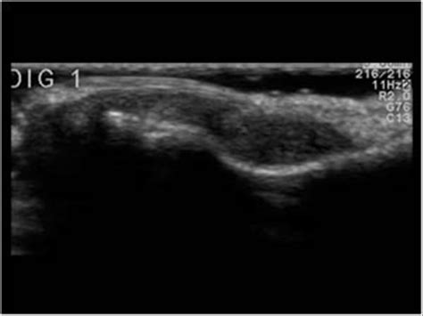 Musculoskeletal Joints And Tendons 64 Fingers Case 645 Tumors