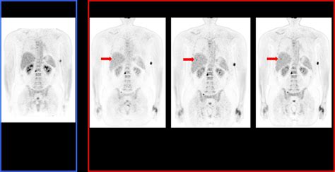 Initial Experience With A New Petct System Using Sipm Detectors Image