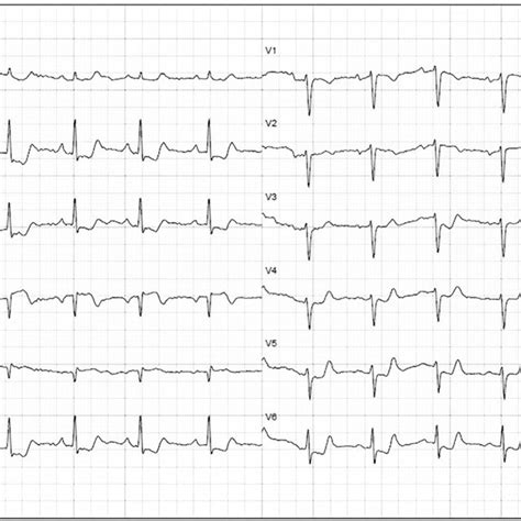 Effort‐induced St‐segment Depression In Twelve‐lead Electrocardiogram Download Scientific