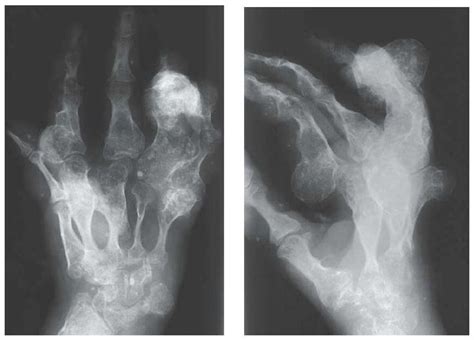 Maffucci Syndrome Multiple Metacarpal And Phalangeal Lesions With Chondroid Matrix
