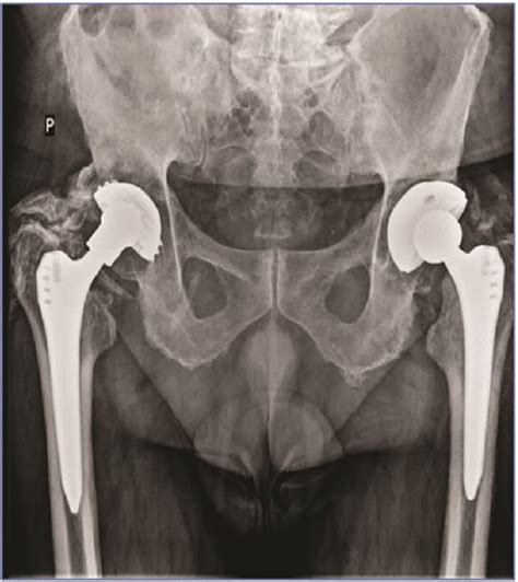 Spotting Heterotropic Ossification Dynamic Chiropractic