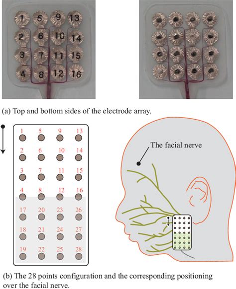 Figure 1 From Selective Facial Nerve Stimulation With An Array